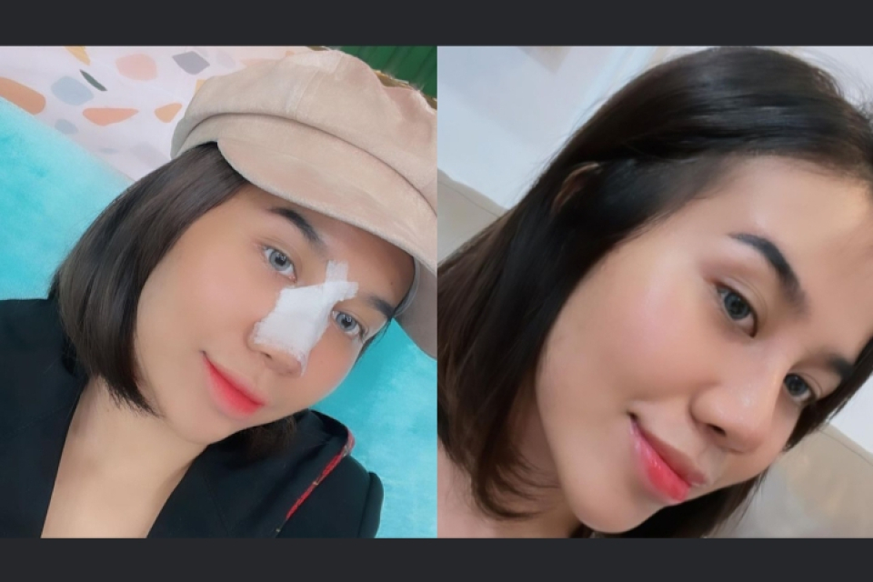 Mayang Pamer Hidung Baru Usai Jalani Operasi Plastik - Hits Katadata.co.id